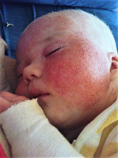 What is eczema? – Eczema Outreach Support